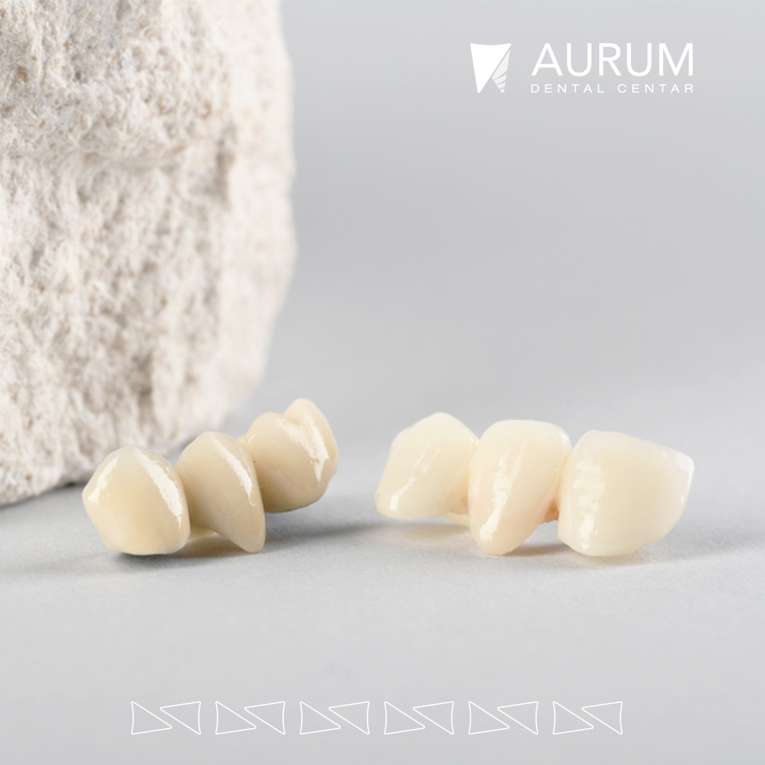 Zubne krunice ili zubne navlake, porculan, keramika, cirkon – Aurum ...